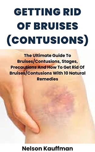 GETTING RID OF BRUISES (CONTUSIONS): The Ultimate Guide To Bruises ...
