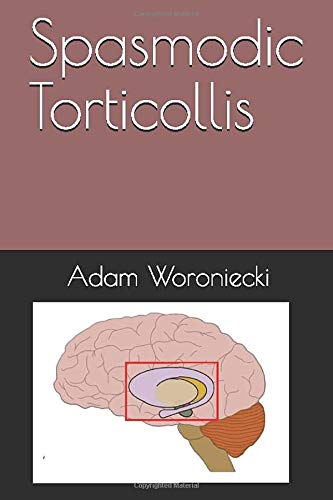 Spasmodic Torticollis: Woroniecki, Adam: 9781096081524: Amazon.com: Books
