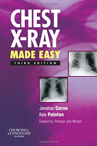 Chest X-Ray Made Easy: Corne MA PhD MB BS FRCP, Jonathan, Pointon MRCP ...