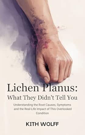 Lichen Planus: What They Didn’t Tell You : Understanding the Root ...