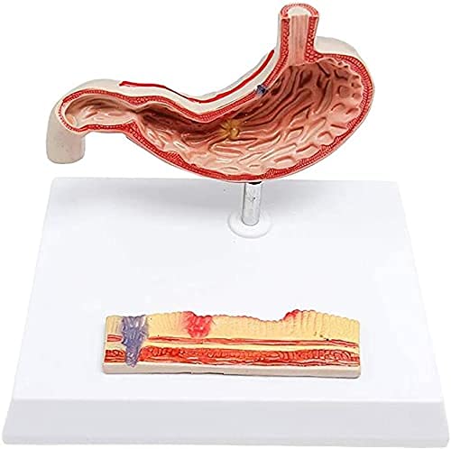 Buy IJNBHU Study Model Educational Model tric Ulcer Anatomy Model ...