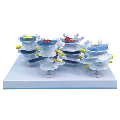 Buy HX Human Spine Model - Anatomical Skeletal Model of Diseased ...