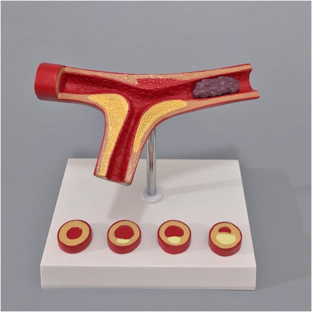 Coronary Heart Disease Anatomy Model, Human Artery Atherosclerosis and ...