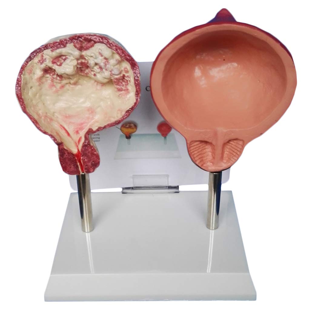 Medical Bladder Model A Comparative Model Of Smoking Bladder Normal ...