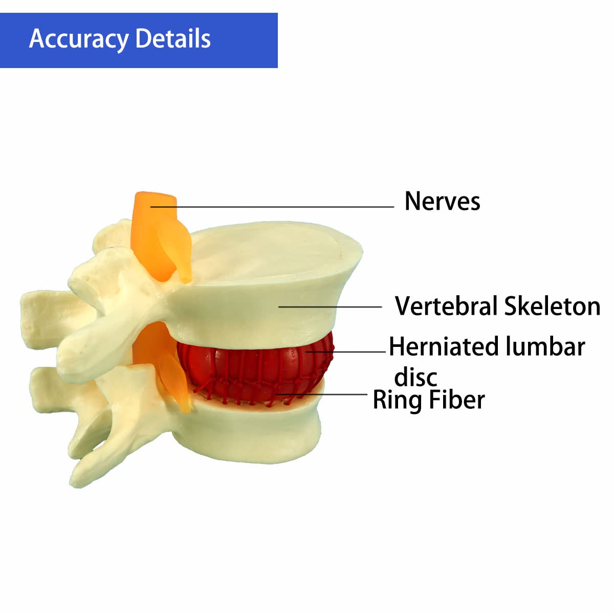 Human Anatomical Lumbar Disc Herniation Model, 1.5 Philippines | Ubuy
