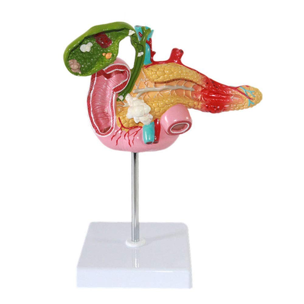 Qhyxt Pathological Model Of Pancreas Duodenum And Gallbladder Human ...