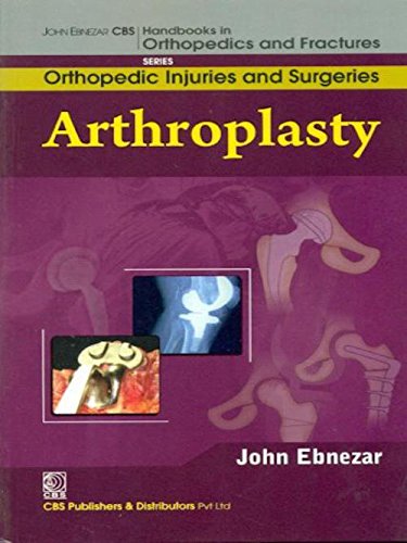 Buy ARTHROPLASTY (HANDBOOKS IN ORTHOPEDICS AND FRACTURES SERIES VOL 62 ...