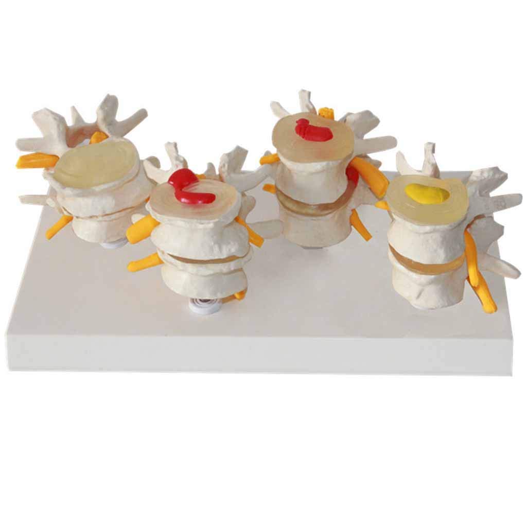 Buy Study Model Human Anatomy Science Models, Human Lumbar Lesion Spine ...