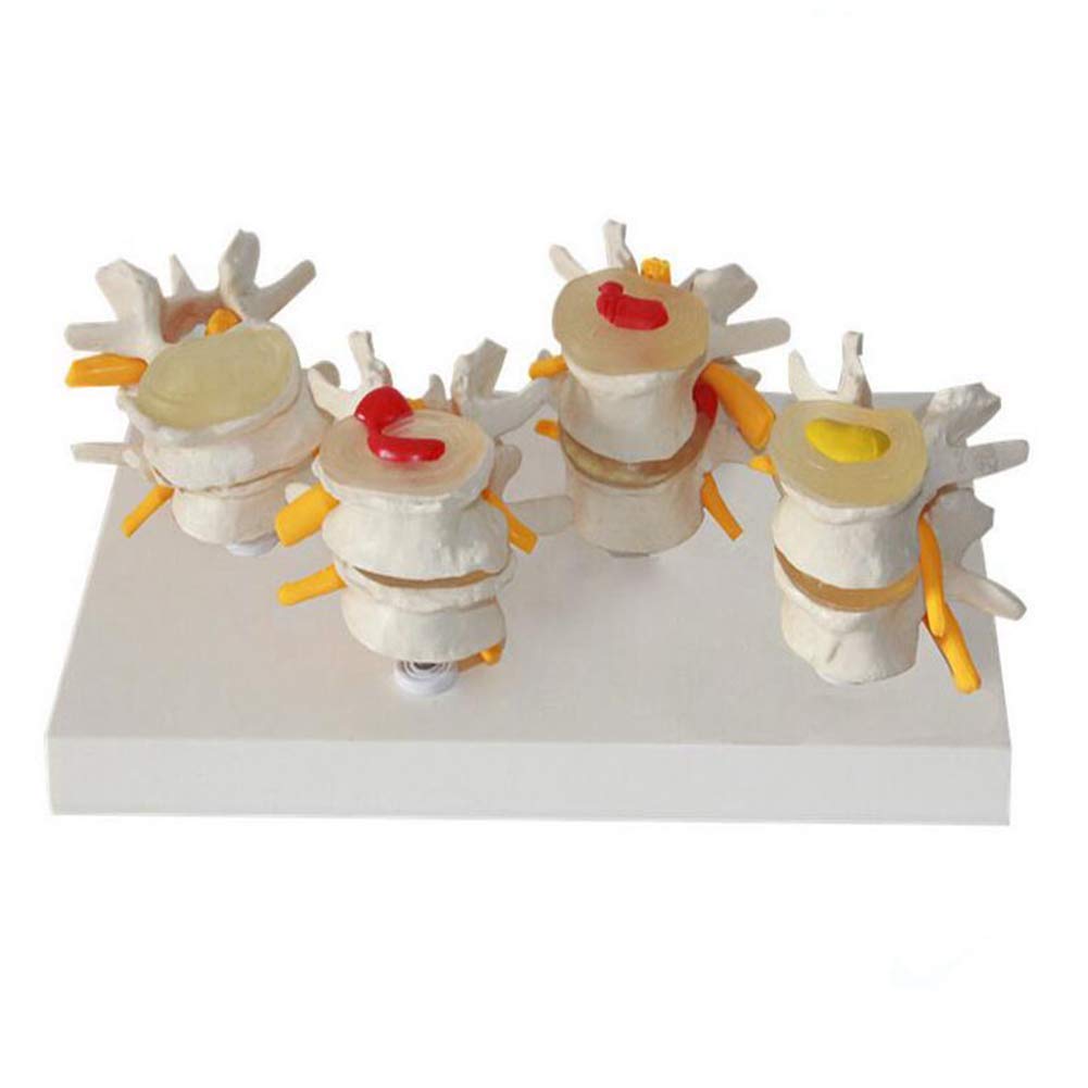 Buy Anatomy Model, Assembly Lumbar Spine Diseased Model 4- Stage Human ...