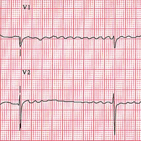 Amazon.com: Update on Atrial Fibrillation: Review of the New AHA/ACC ...