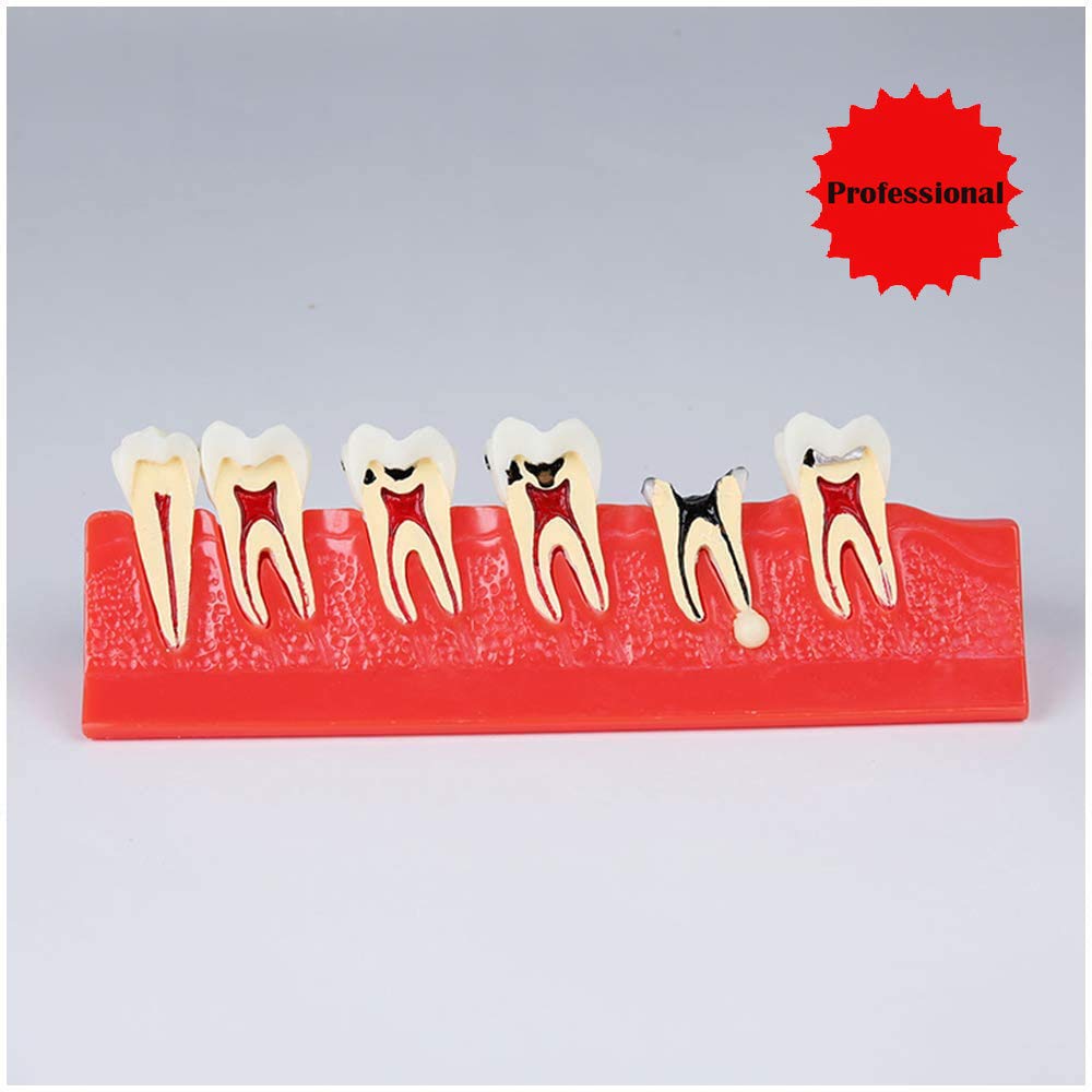 Buy FHUILI Dental Caries Model - Anatomy Teeth Model - Development of ...
