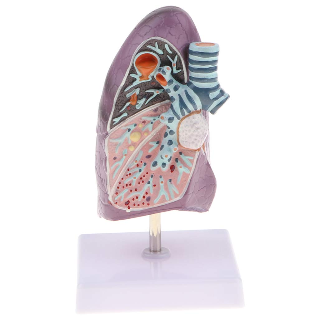 Buy SaniMomo 2/3 Life Size Diseased Lung Structure Respiratory System ...