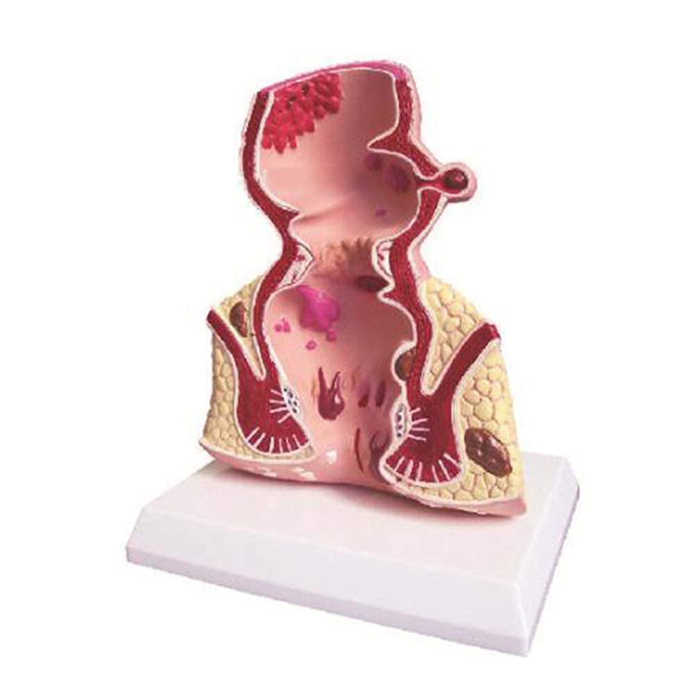 Ivqapp Rectal Model Human Organ Anatomy Model Rectal Pathology Model ...