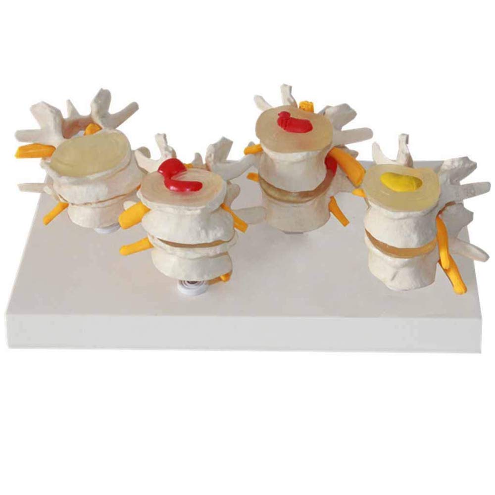 Buy The Diseased Model of Vertebrae,Human Lumbar Vertebral Spine ...