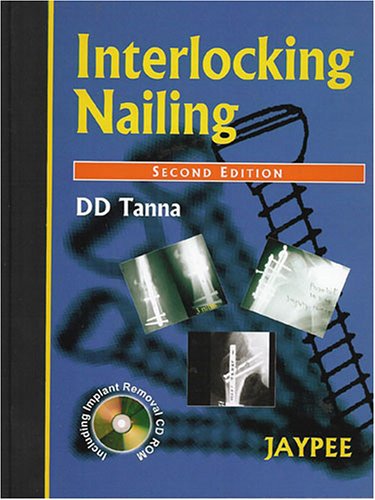 Interlocking Nailing: 9788180612275: Medicine & Health Science Books ...