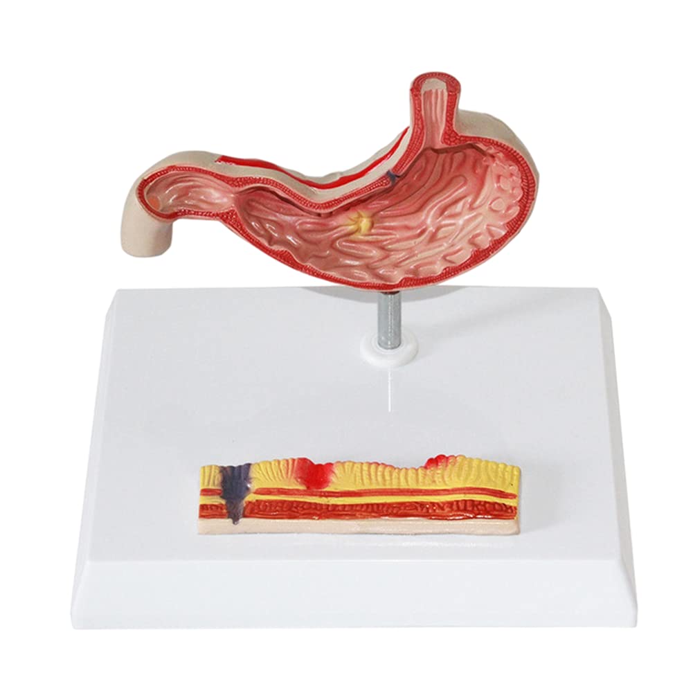 Buy CSL Human tric Ulcer Model,Anatomy Model of tric Ulcer,Stomach ...