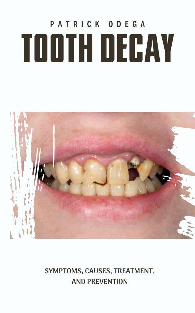 Amazon | TOOTH DECAY: Symptoms, Causes, Treatment, and Prevention ...