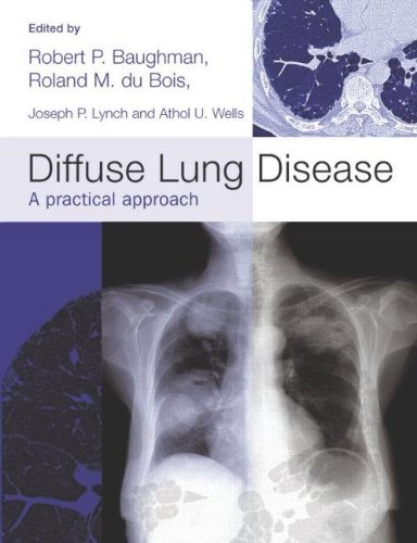 Diffuse Lung Disease: A Practical Approach: 9780340810149: Medicine ...