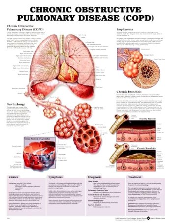 Chronic Obstructive Pulmonary Disease (COPD) Anatomical Chart ...