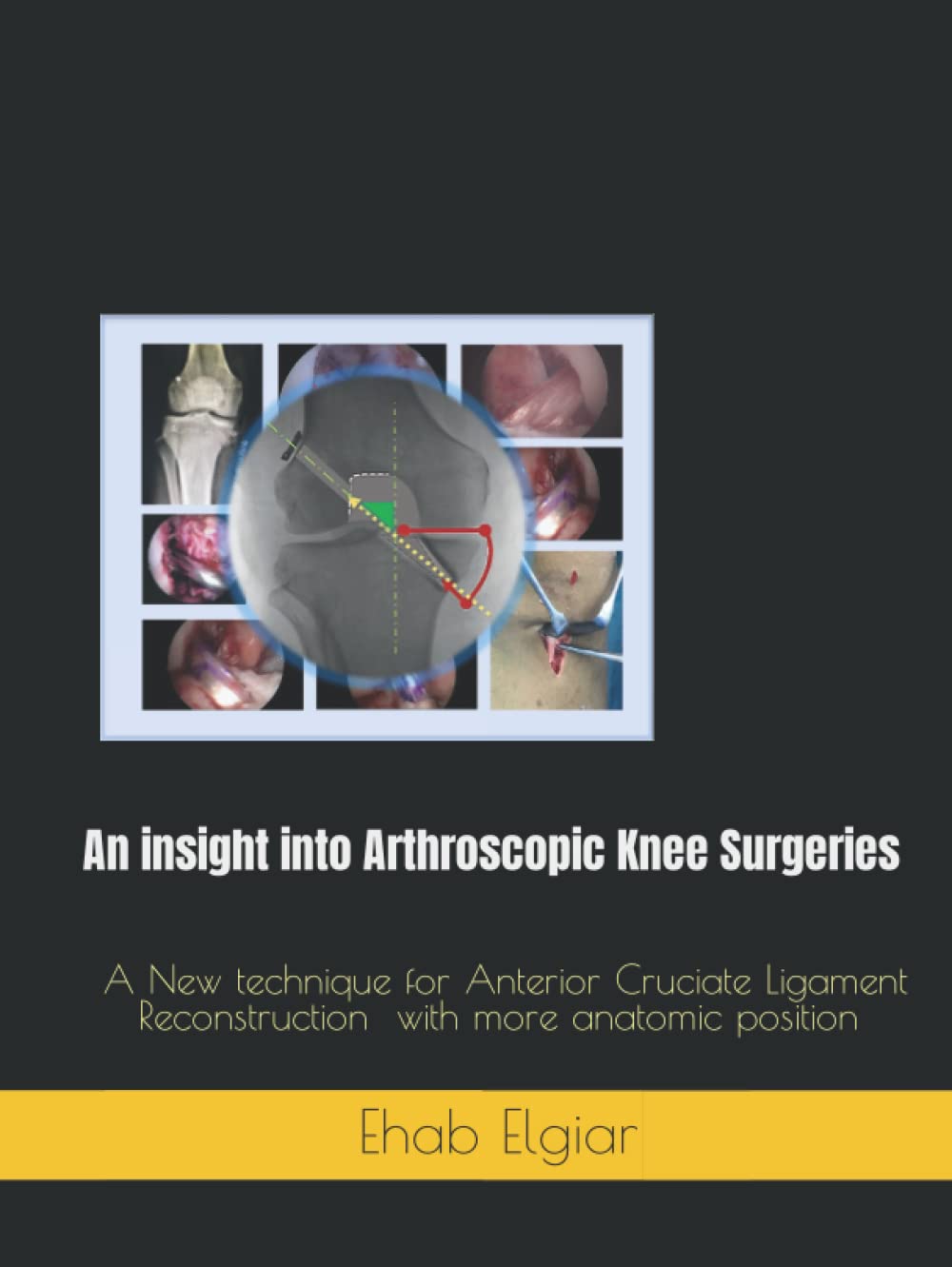 An Insight Into Knee Arthroscopic Surgeries New Technique For Anterior ...