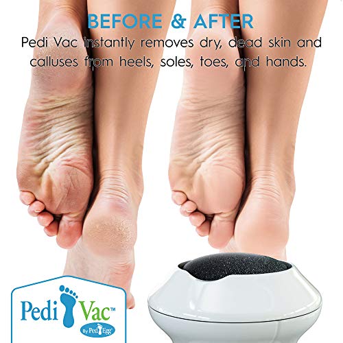 Pedi Vac by Ped Egg - Callus Remover for Feet with Built-in Vacuum Removes Dead Skin from Feet ...
