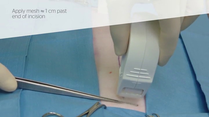 Watch Ethicon DERMABOND PRINEO Skin Closure System ﹙60 cm﹚, CLR602US ...