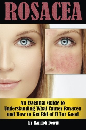 Rosacea: An Essential Guide to Understanding What Causes Rosacea and ...