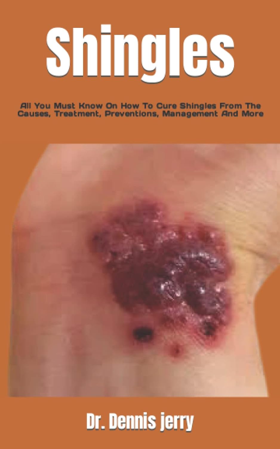 Shingles: All You Must Know On How To Cure Shingles From The Causes ...