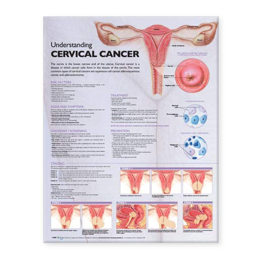 Understanding Cervical Cancer Anatomical Chart Laminated : Anatomical ...