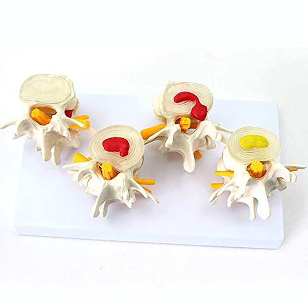 Buy Body Model 10 Human Spine Model - Anatomical Lumbar Spine Lesion ...