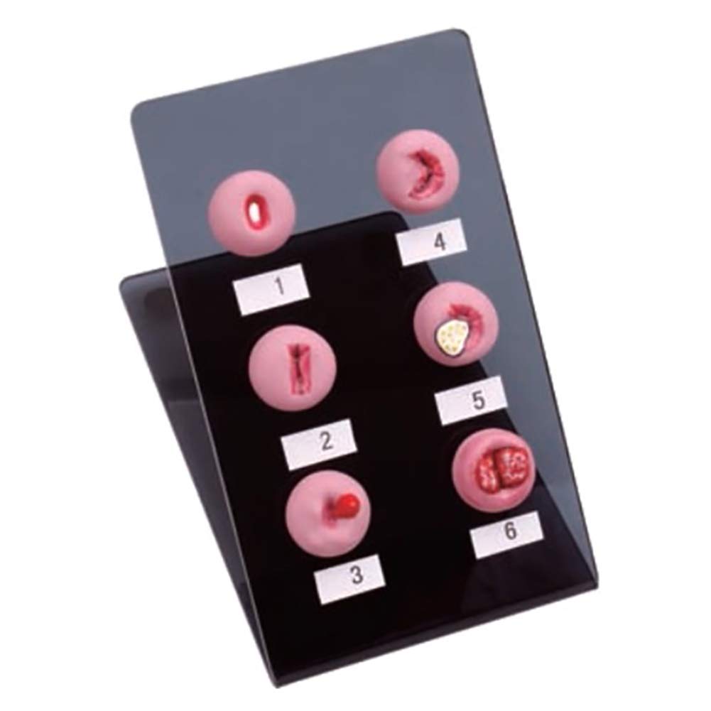 buy-the-neck-of-uterus-lesion-model-shows-the-structural-features-of