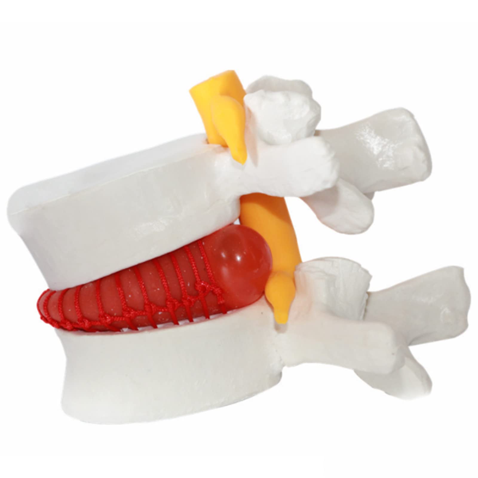 Buy Anatomical Human Disc Herniation Model Vertebras Anatomicas Lumbar ...