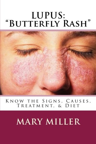 Lupus Butterfly Rash: Know the Signs, Causes, Treatment, & Diet ...