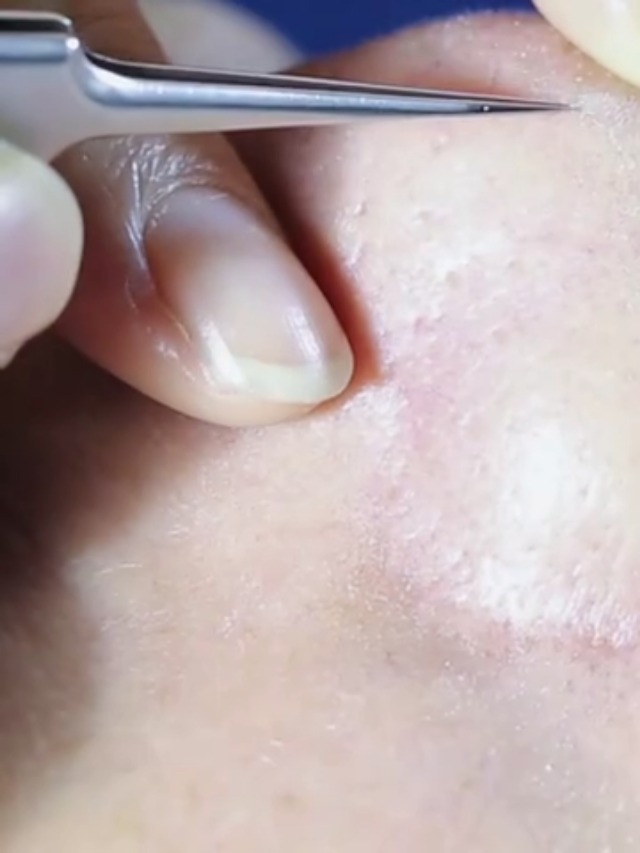 Watch How to use the blackhead removal tools on Amazon Live