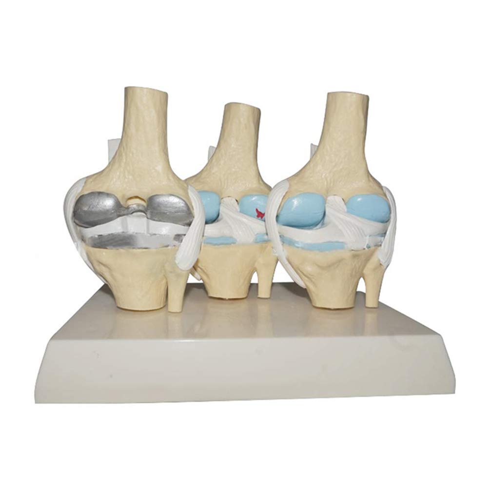 Csatai Human Knee Model Stages Of Lesions Knee Model Joint | Desertcart ...