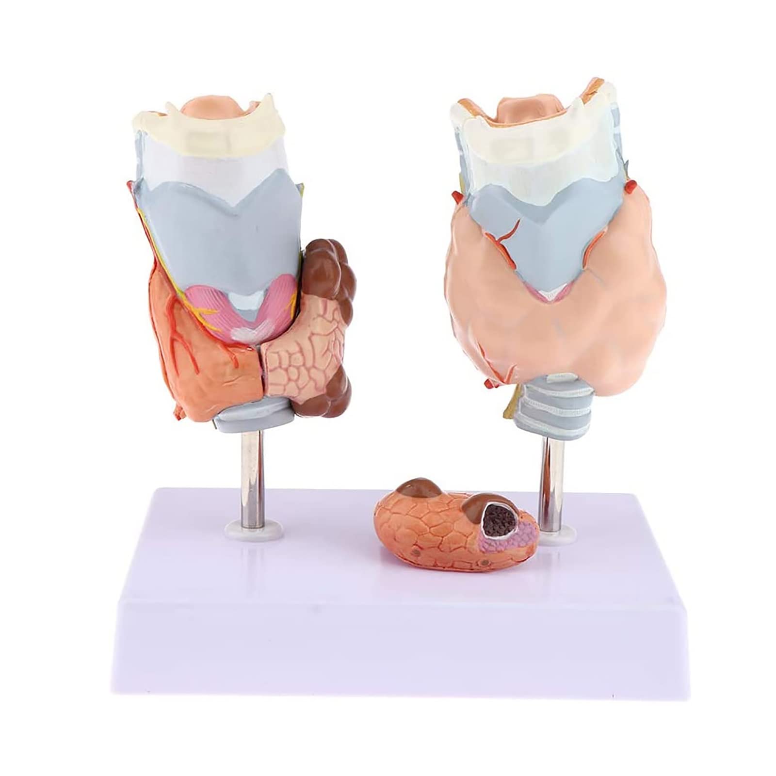 Buy Thyroid Pathology Model, Thyroid Endocrine Disease Throat Model ...