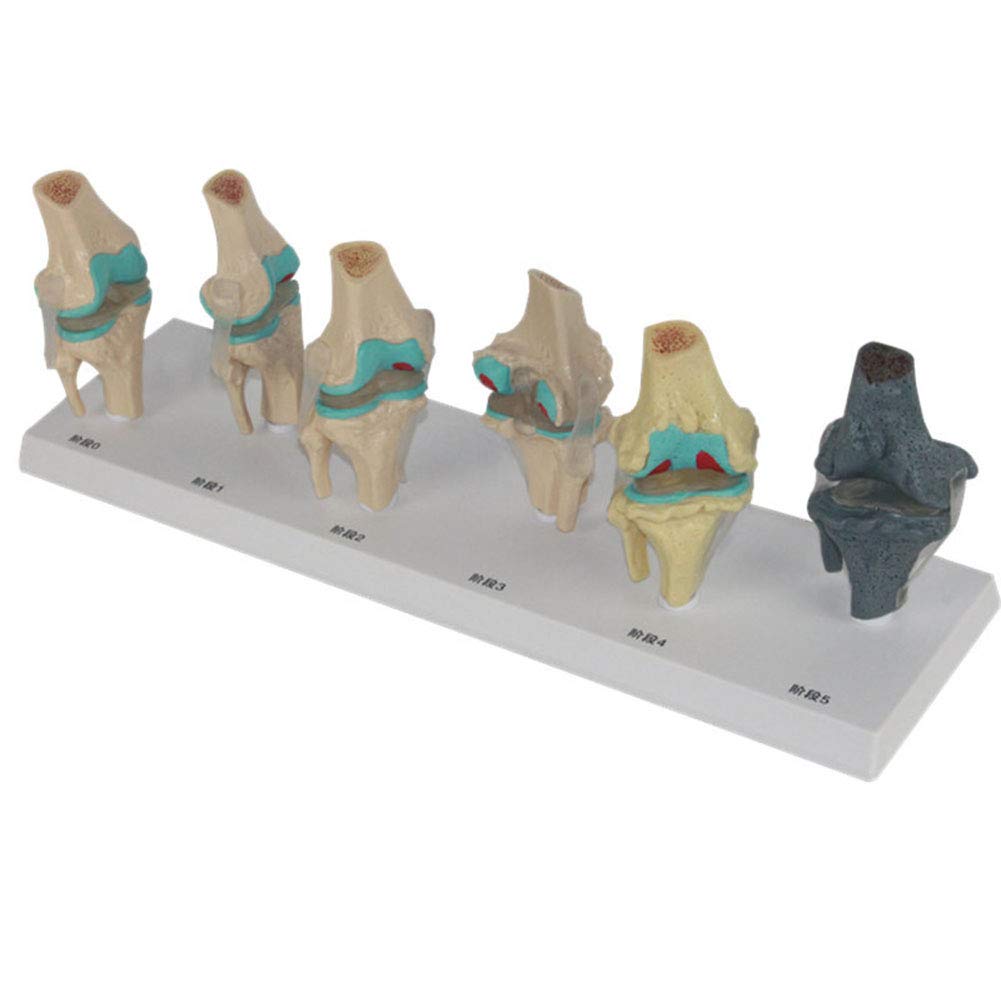 Buy Knee Joint Models, Shows the 6 Stages of Lesions Experienced by the ...