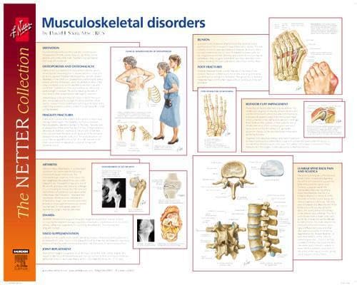 Buy Frank H. Netter Musculoskeletal Disorders Poster (European Netter ...