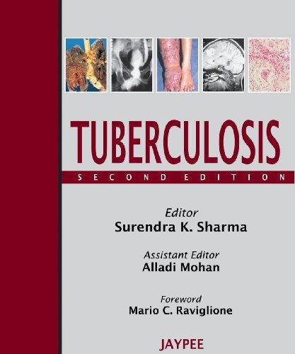 Amazon.com: TUBERCULOSIS eBook : Sharma, Surendra K, Mohan, Alladi ...