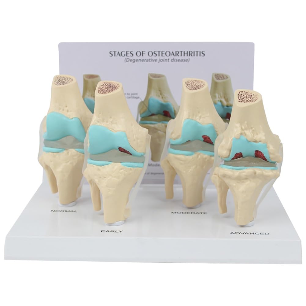 Amazon.com: TPMCOS Knee Joint Disease Model Set of 4 Stages of ...