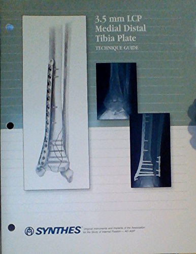 3.5 mm LCP Medial Distal Tibia Plate Technique Guide: Synthes: Amazon ...