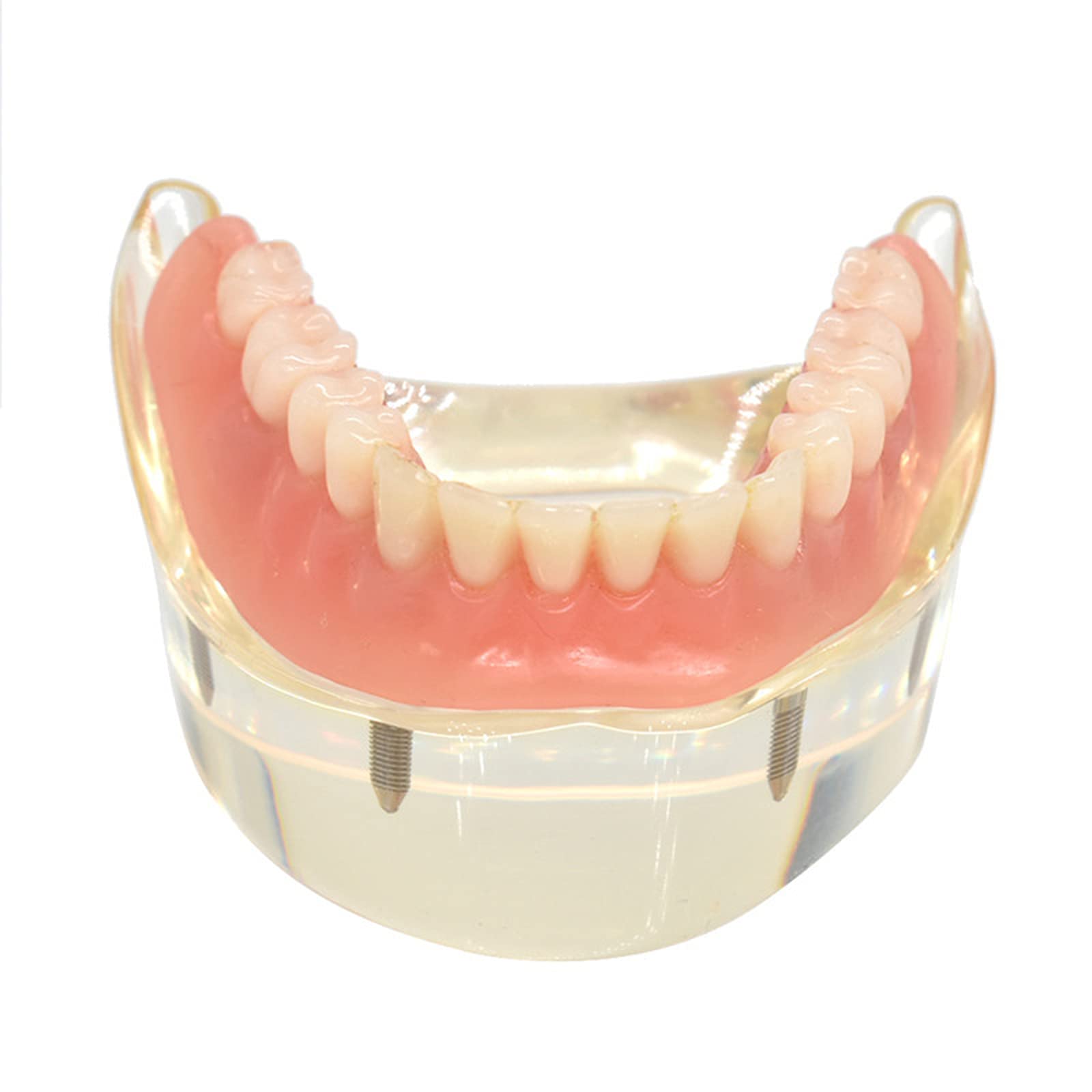 Buy Dental Restoration Model, Oral Overdenture Tooth Model, Mandibular ...