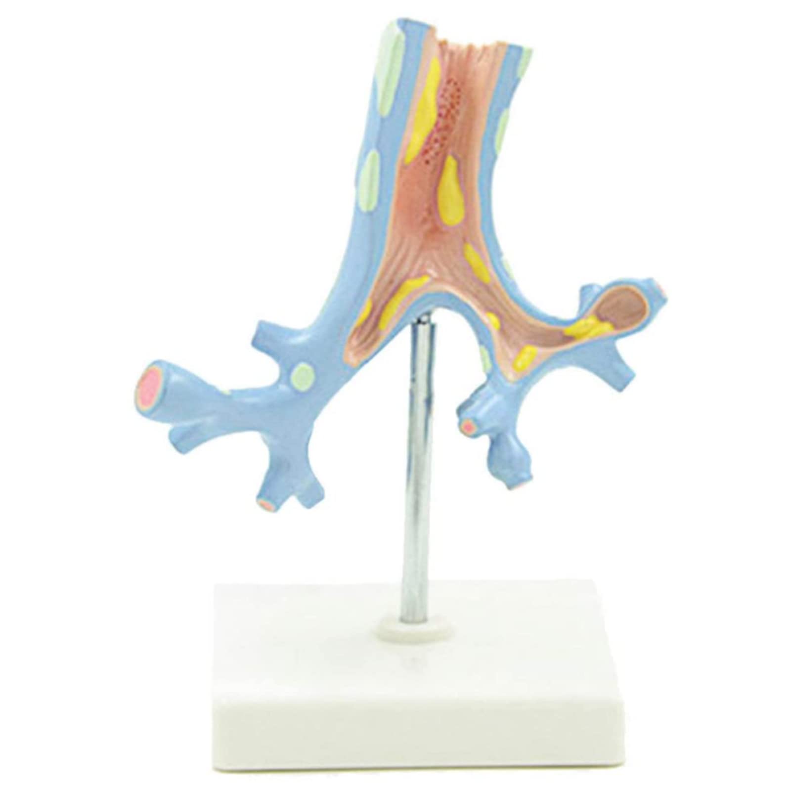 Buy The Bronchial Pathology Model Shows The Common Bronchial Lesions ...