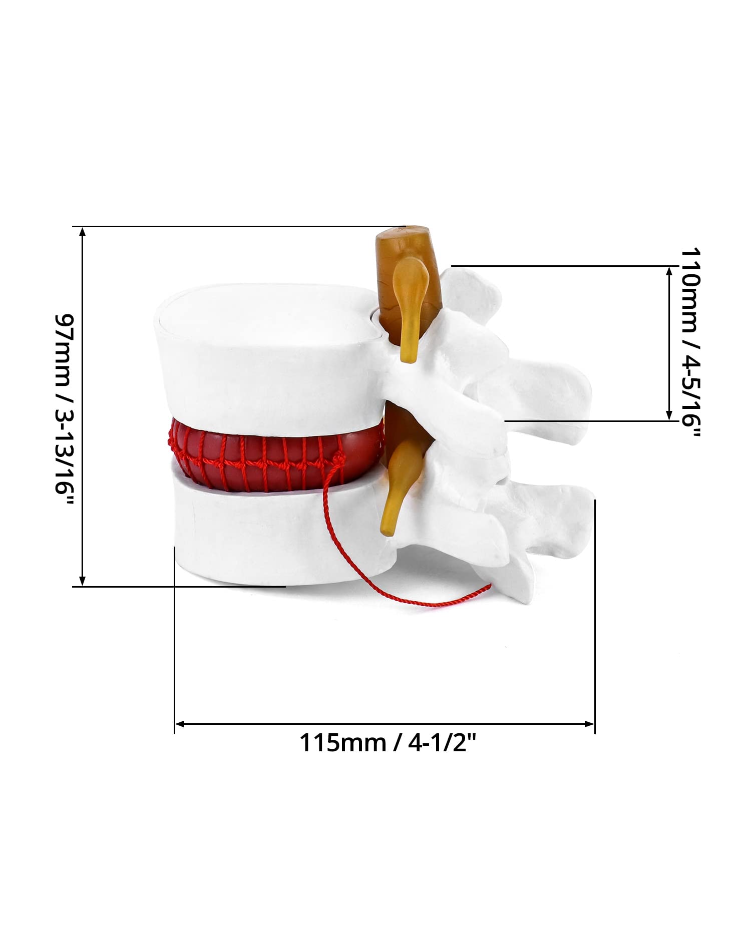 Degenerative Disc Disease Lumbar ANATOMICAL LUMBAR DISC Herniation ...