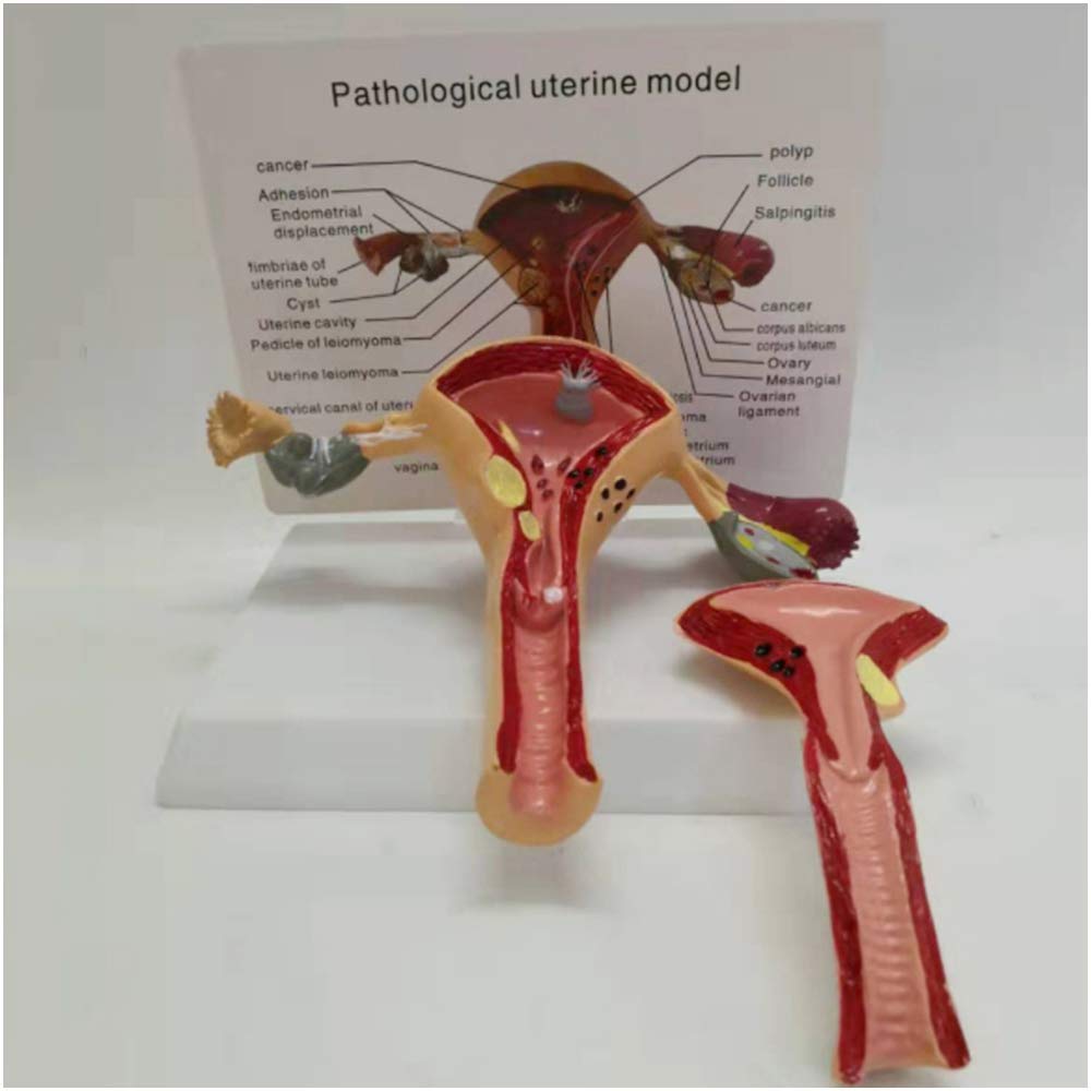 Buy DBSCD Pathological Model of Uterus - Uterus Model Science ...