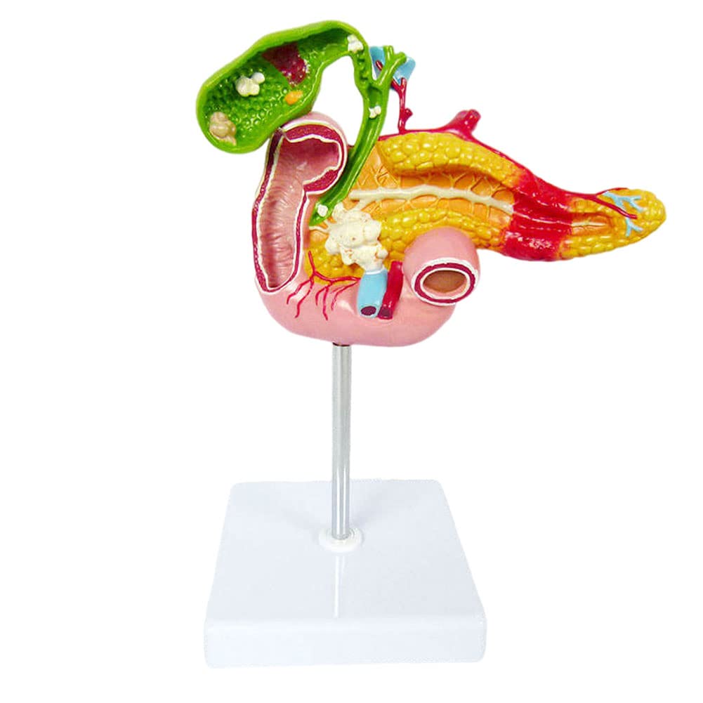 Buy BEAGHTY Pathological Model of Pancreas, Duodenum and Gallbladder ...