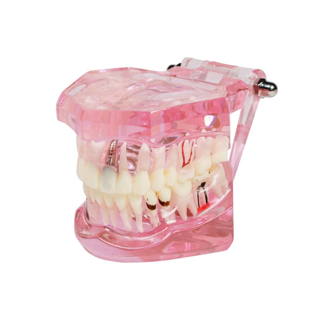 Buy XIEJI Dental Teeth Teaching Model Dental Im Bridge Bristle Crown ...
