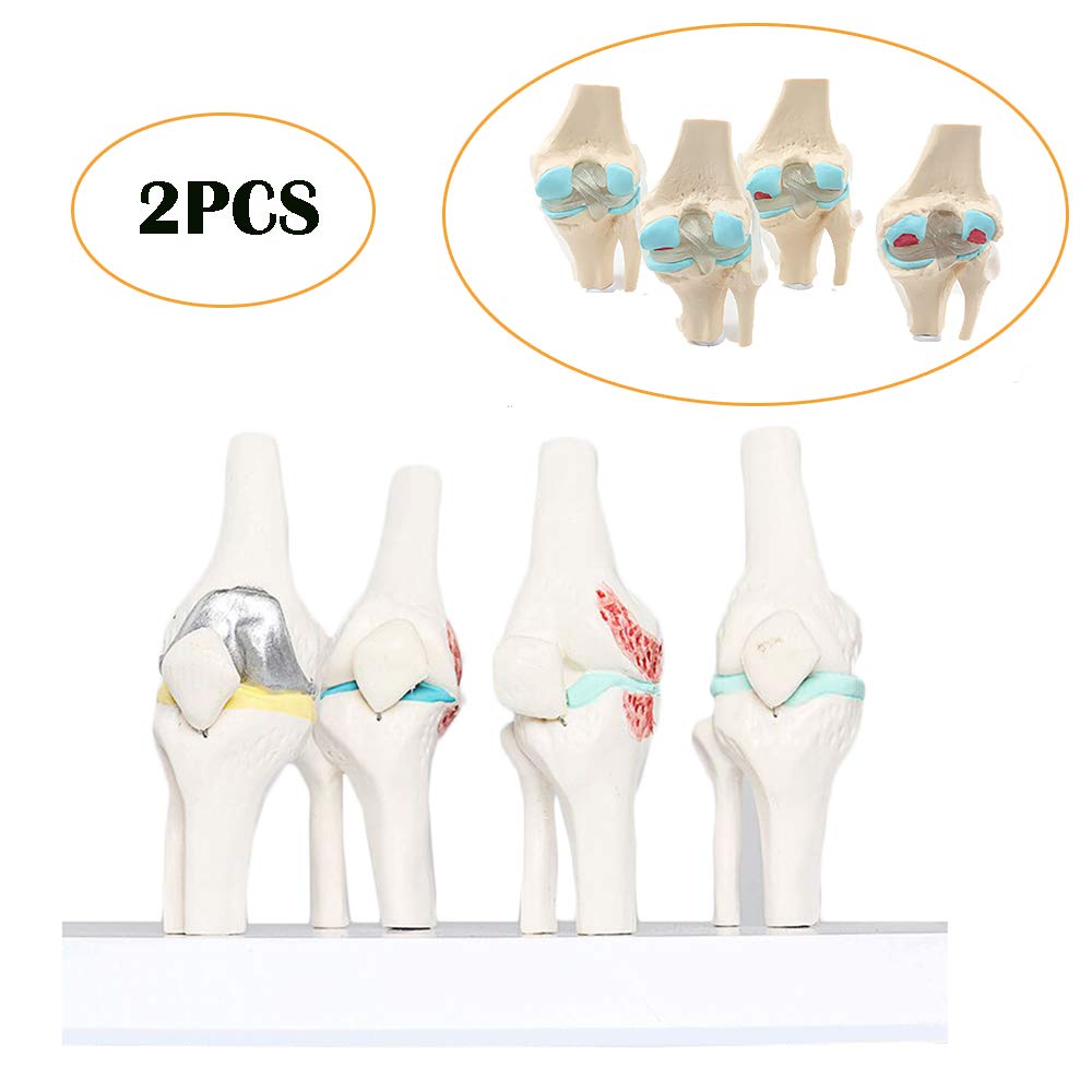 Buy FHUILI Human Knee Model - 4 Stage Normal and Disease Knee Joint ...