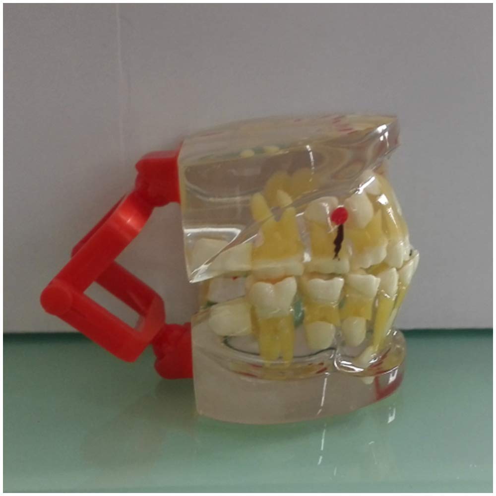 Buy QHYXT Anatomy Teeth Model - Pathologic Deciduous Teeth Model ...