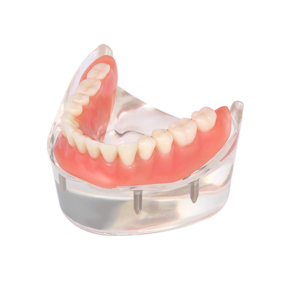 Buy Generic Dental Overdenture Teeth Model Removable Interior ...